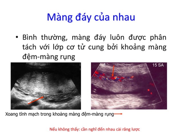 17. Sieu am banh nhau, GS Michel Collet | PDF