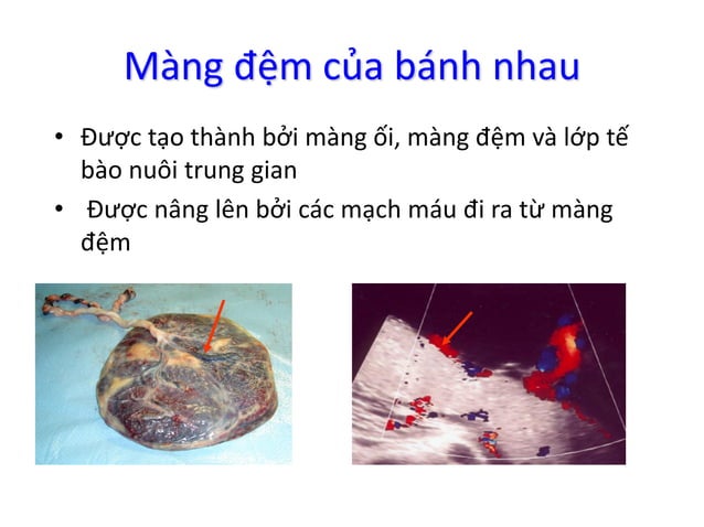 17. Sieu am banh nhau, GS Michel Collet | PDF