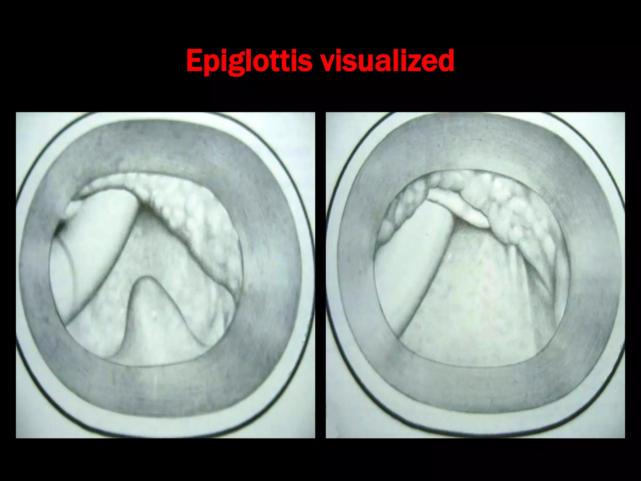 17. laryngoscopy, bronchoscopy, esophagoscopy | PPT