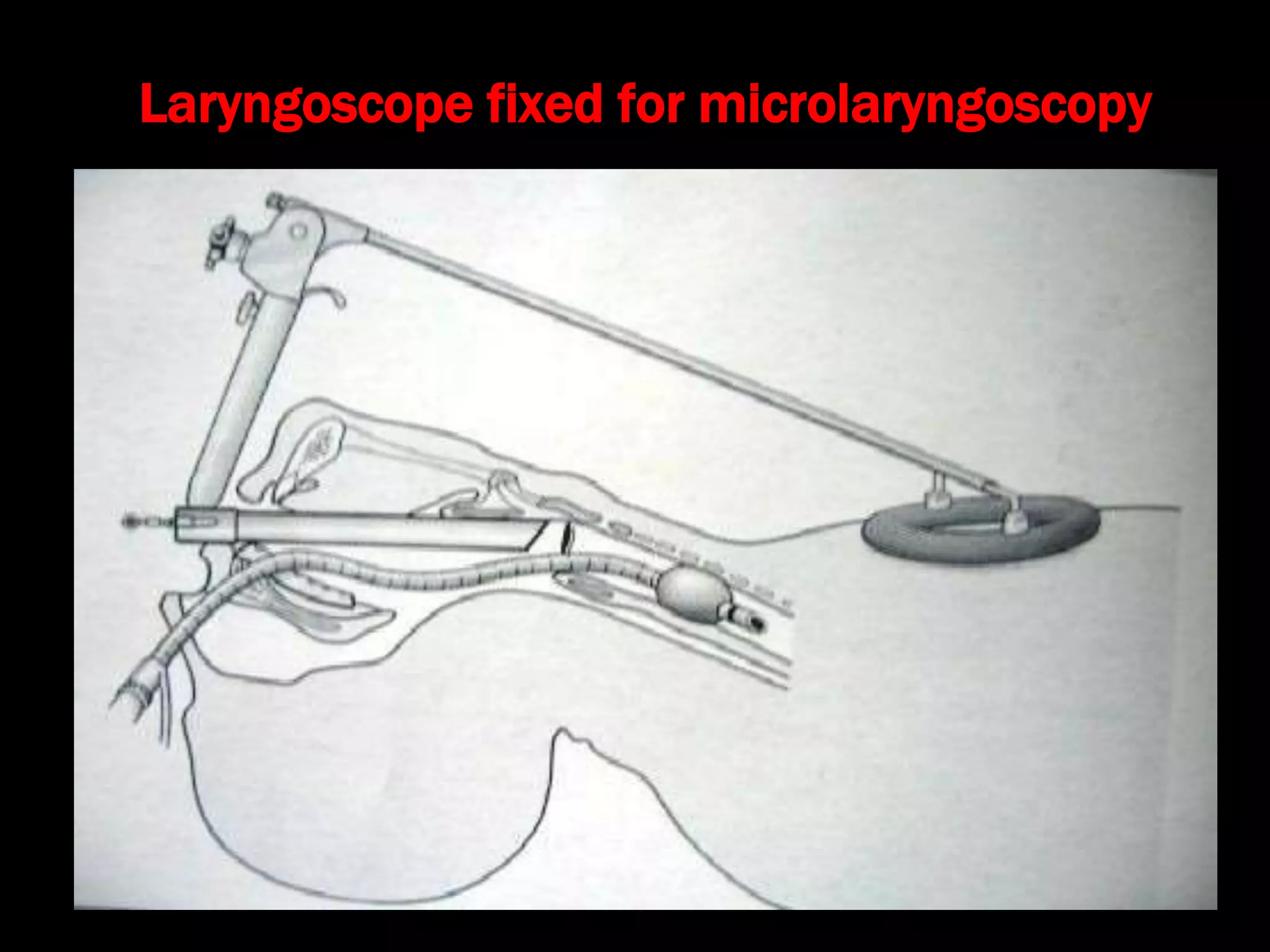 17. laryngoscopy, bronchoscopy, esophagoscopy | PPT