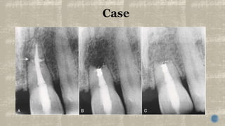 Endodontic Surgery - Apicectomy | PPTX