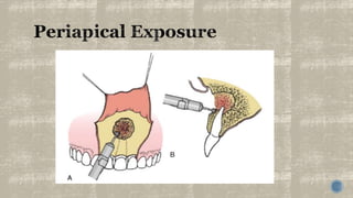 Endodontic Surgery - Apicectomy | PPTX