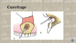 Endodontic Surgery - Apicectomy | PPTX