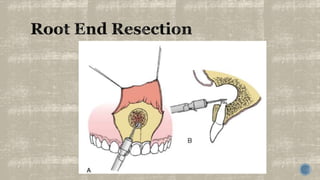 Endodontic Surgery - Apicectomy | PPTX