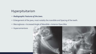 Radiographic Interpretation of Systemic Diseases Manifestations in the ...