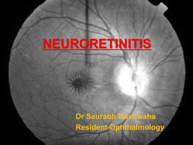 Neuroretinitis | PPT | Eye and Vision Conditions | Diseases and Conditions