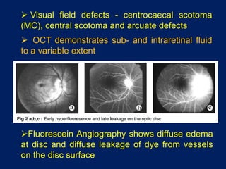 Neuroretinitis | PPT