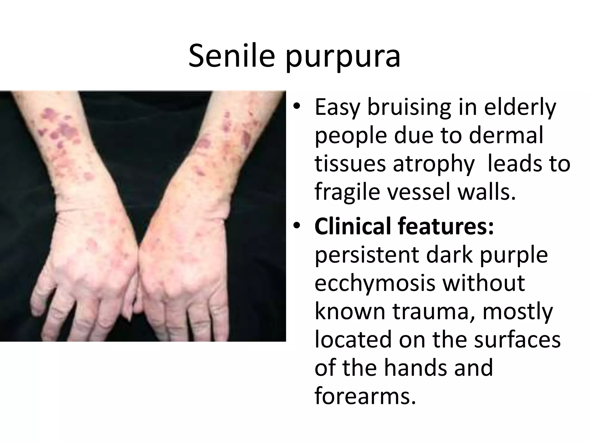 17. HEMOSTASIS DISORDERS.pptx