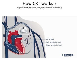 Echo assessment of CRT Candidates | PPT