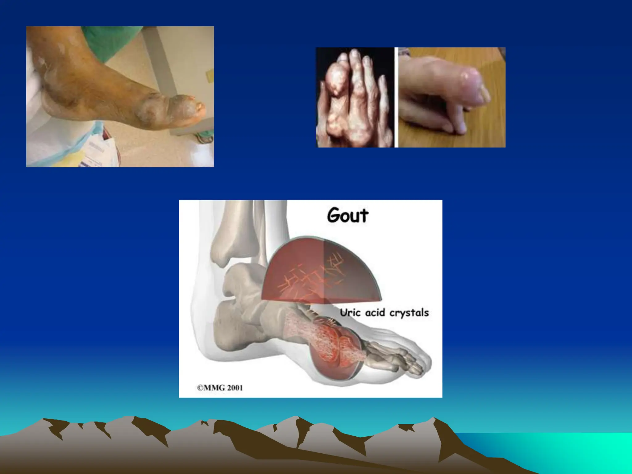 17.gout lecture.ppt
