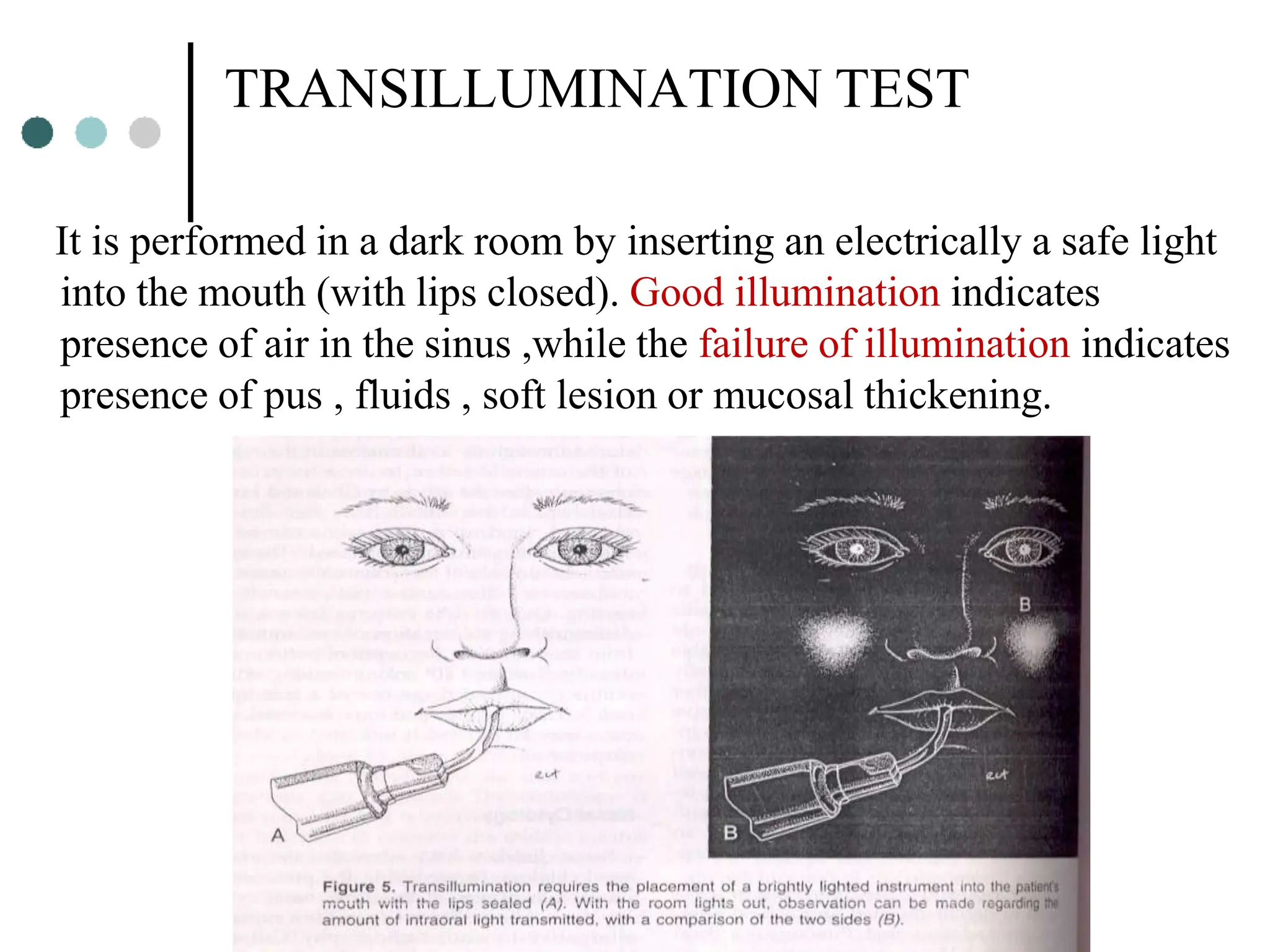 17. Maxillary sinus, antrum of highmore, surgical anatomy | PPTX
