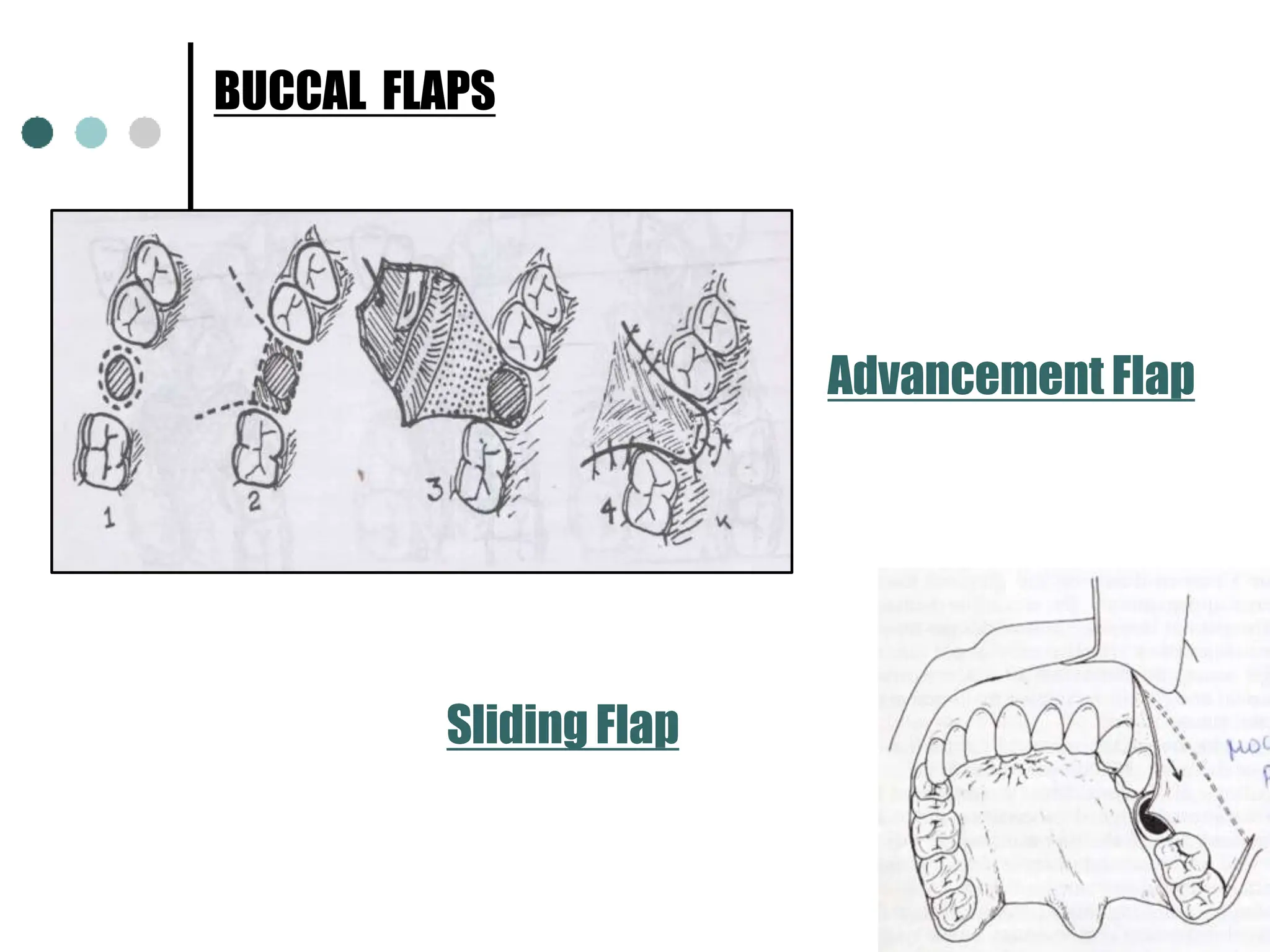 17. Maxillary sinus, antrum of highmore, surgical anatomy | PPTX