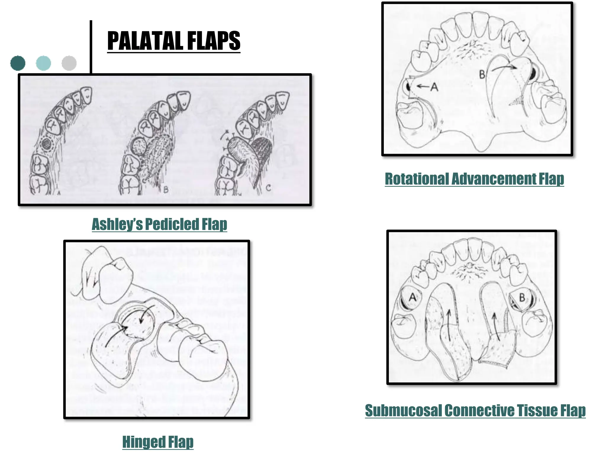 17. Maxillary sinus, antrum of highmore, surgical anatomy | PPTX