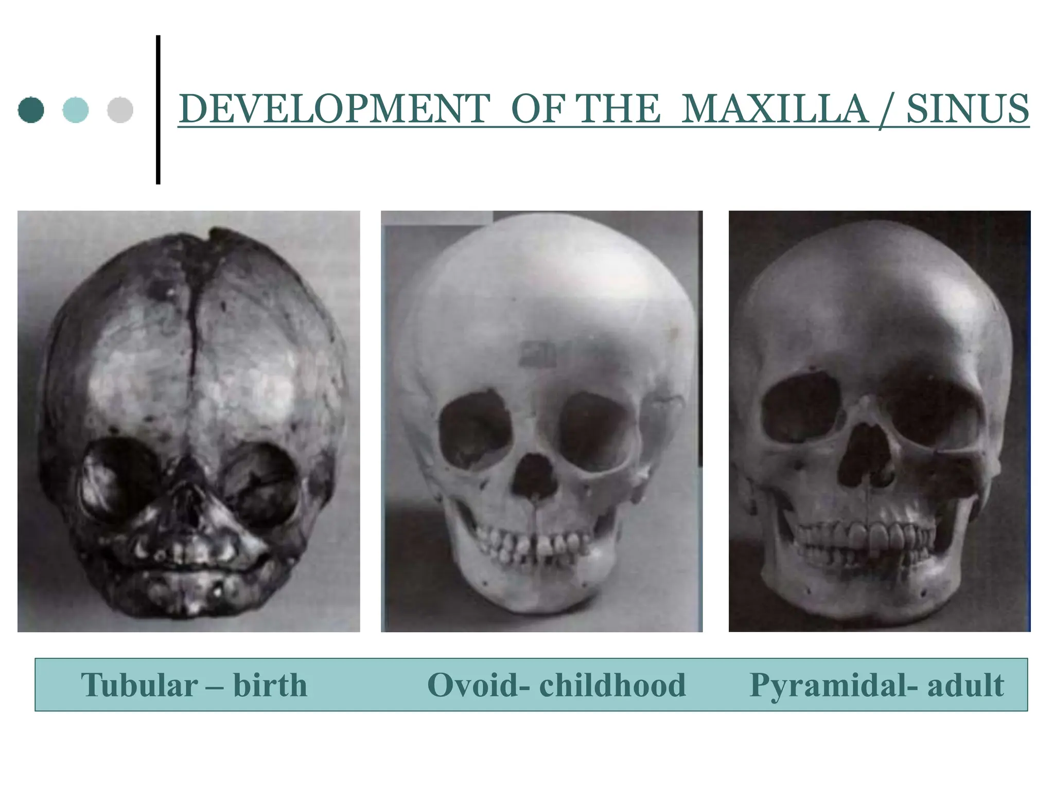 17. Maxillary sinus, antrum of highmore, surgical anatomy | PPTX