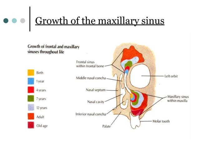 17. Maxillary sinus, antrum of highmore, surgical anatomy | PPTX