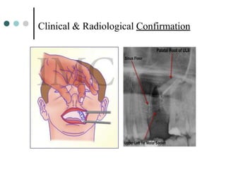 17. Maxillary sinus, antrum of highmore, surgical anatomy | PPTX