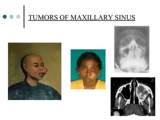 17. Maxillary sinus, antrum of highmore, surgical anatomy | PPTX