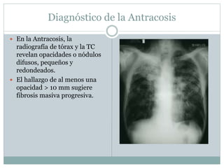 17.-ANTRACOSIS. ANTRACOSIS ANTRACOSISpptx | PPTX