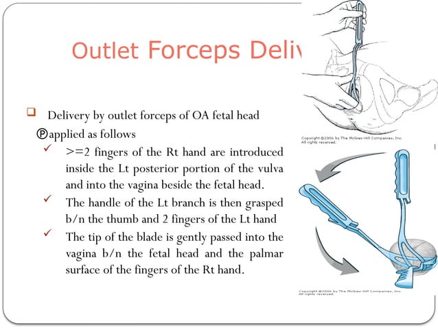 OPERATIVE VAGINAL DELIVERY FORCEPS AND V | PPT
