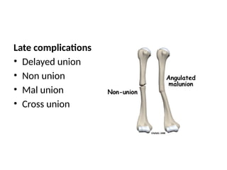 17.FRACTURE MANAGEMENT bds 2.pptx orthopedics | PPT