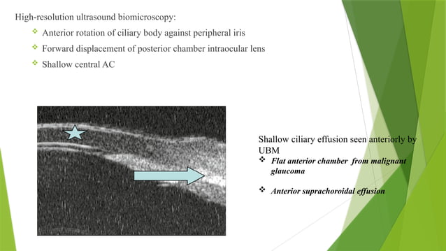 17.1 SECONDARY ANGLE CLOSURE GLAUCOMA.pptx