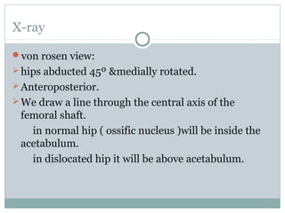 developmental dysplasia of the hip | PPT