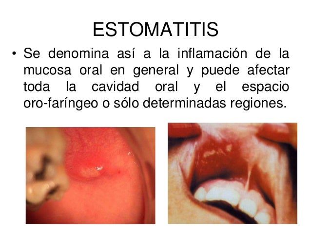 17. estomatitis