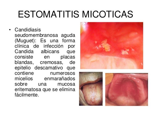 17. estomatitis