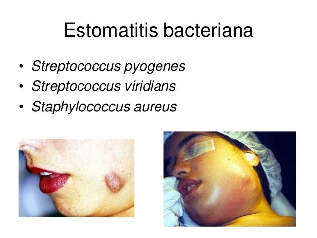 17. estomatitis