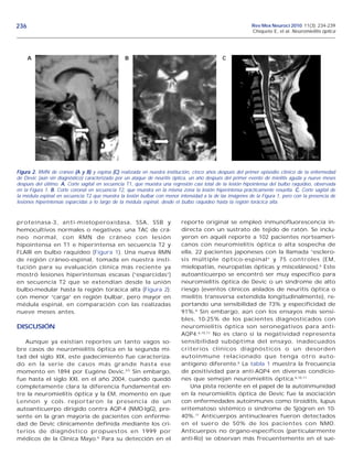 17. neuromielitis óptica de devic reporte de caso | PDF
