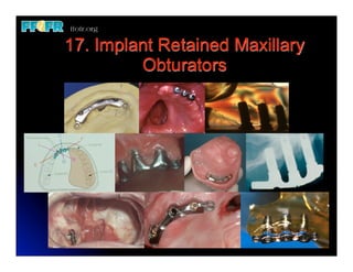 17. (new)implant retained maxillary obturators | PDF