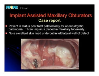 17. (new)implant retained maxillary obturators | PDF