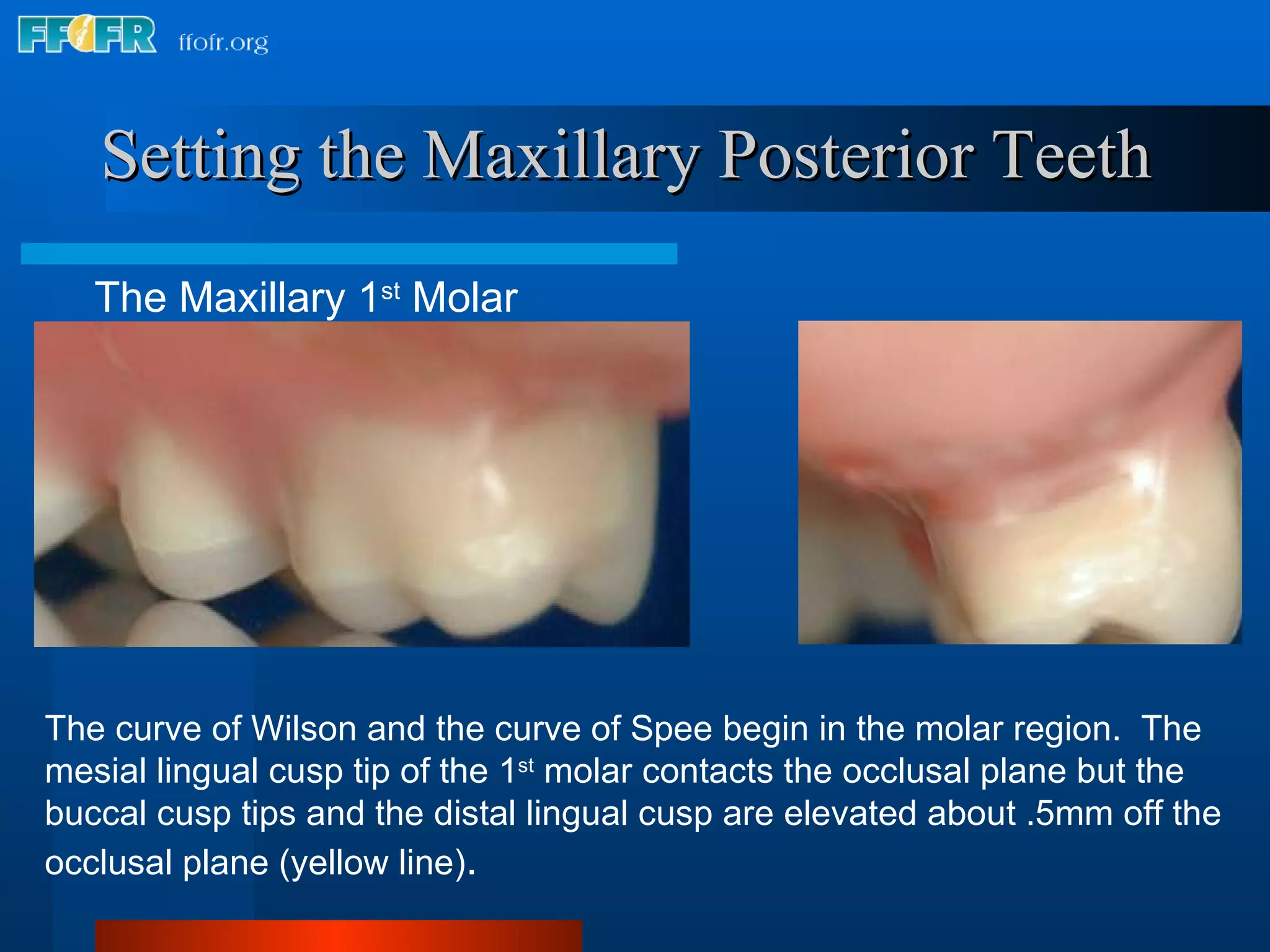 17.occlusal schemes anatomic and semiamatomic occlusion | PPT