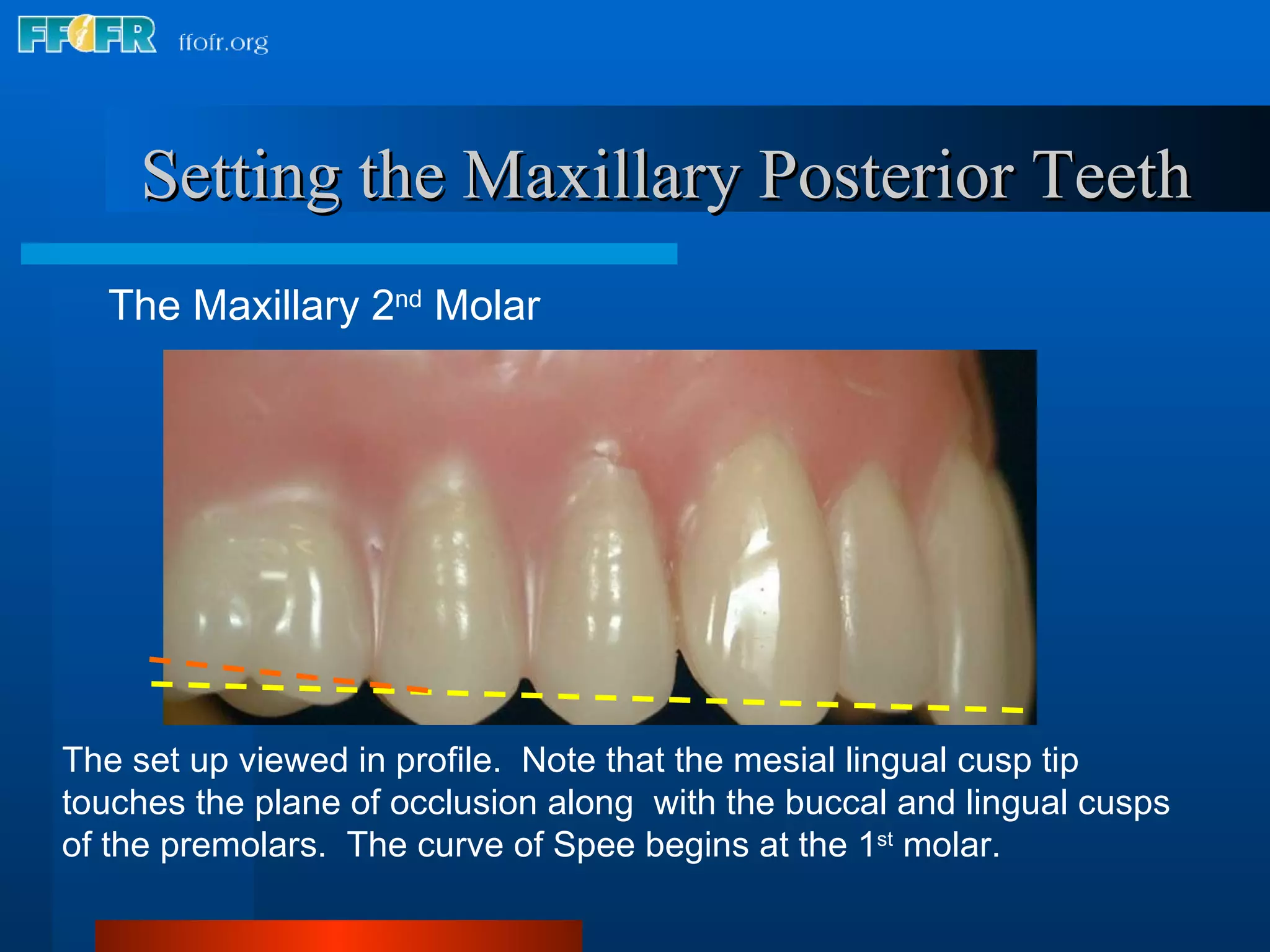 17.occlusal schemes anatomic and semiamatomic occlusion | PPT