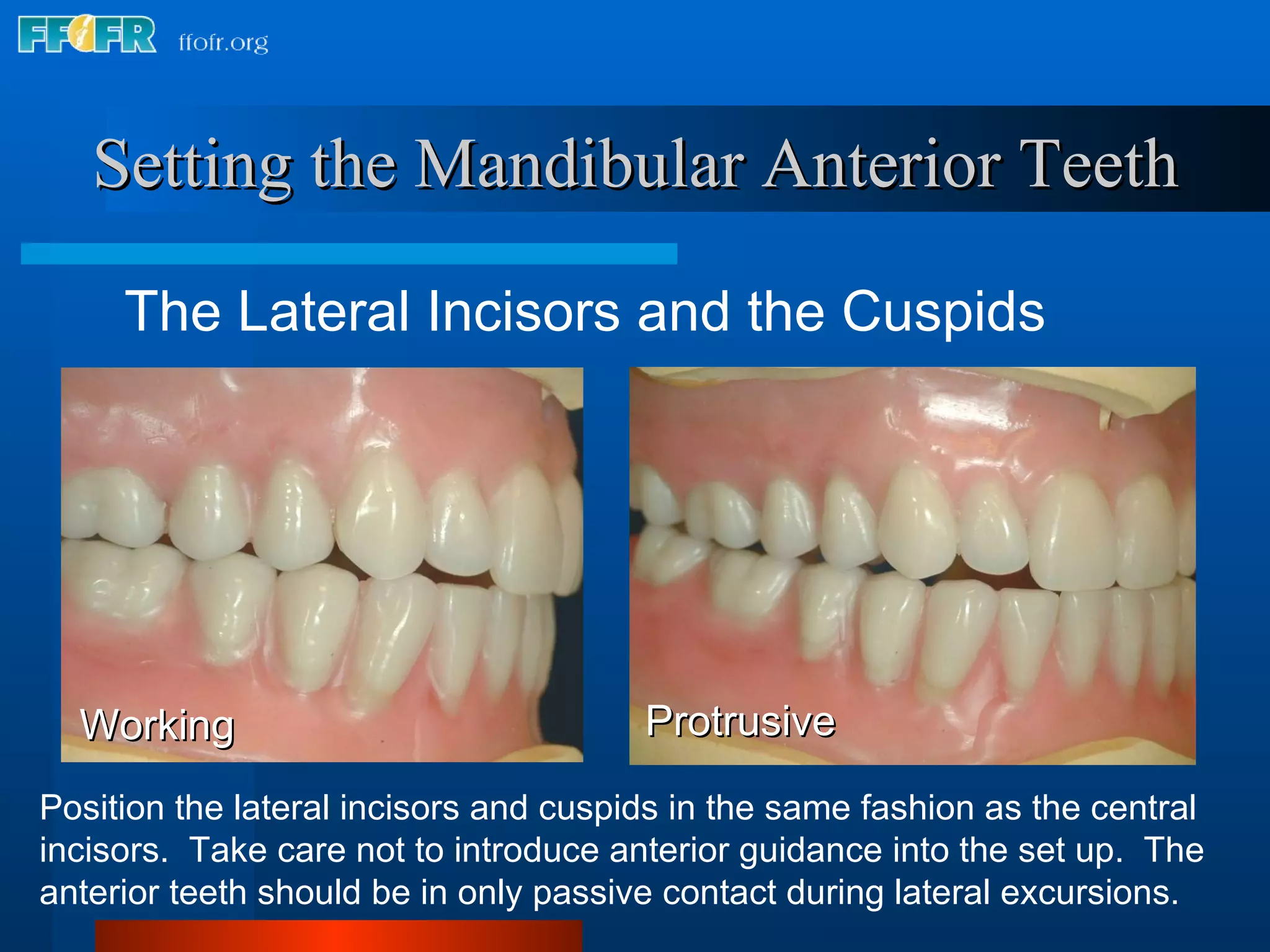 17.occlusal schemes anatomic and semiamatomic occlusion | PPT