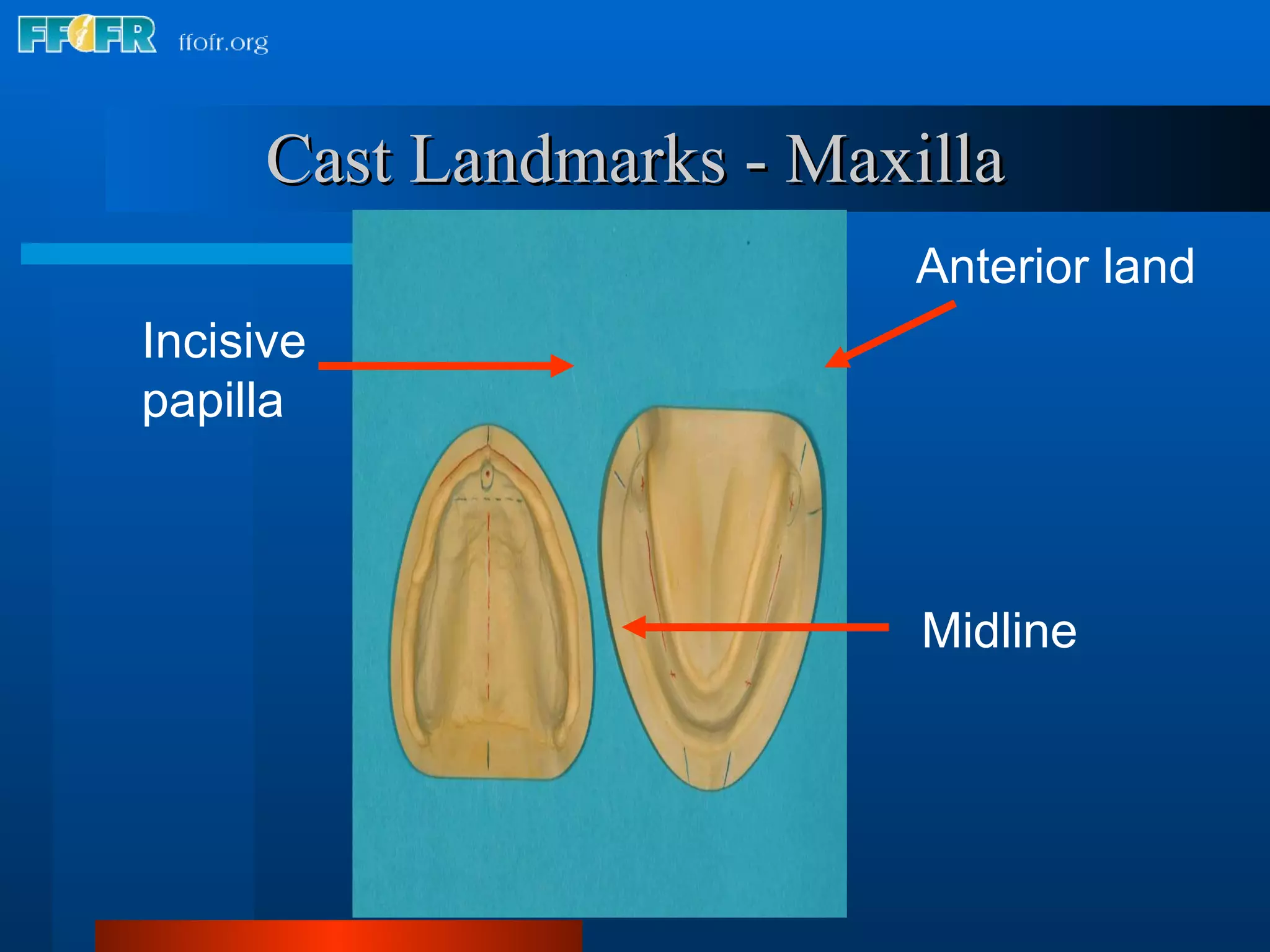 17.occlusal schemes anatomic and semiamatomic occlusion | PPT