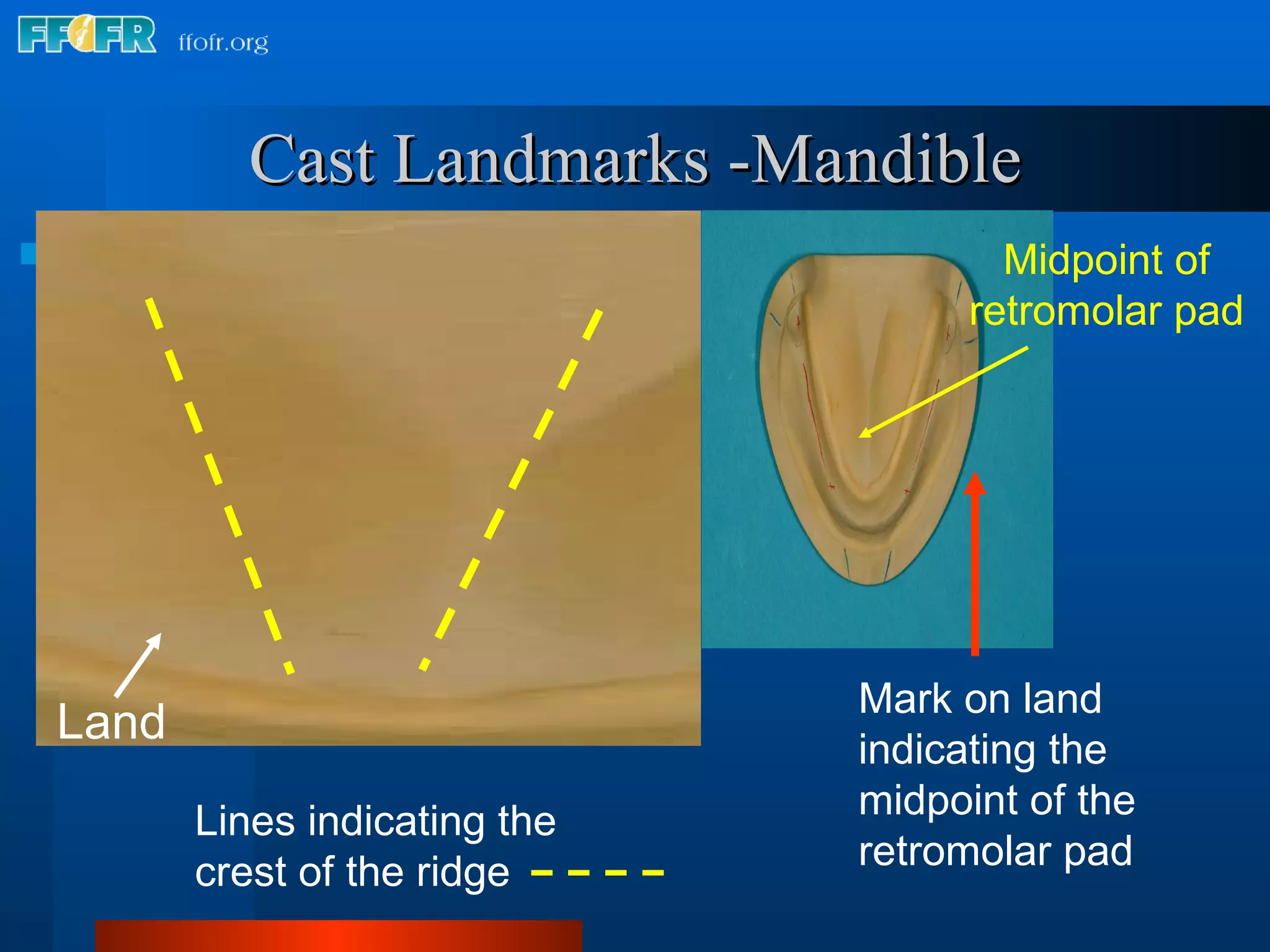 17.occlusal schemes anatomic and semiamatomic occlusion | PPT