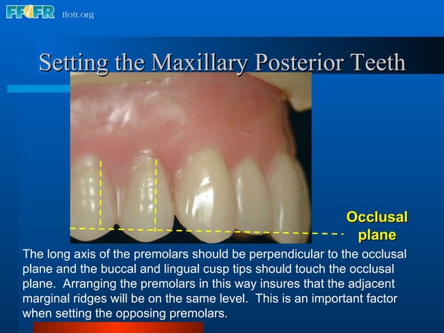 17.occlusal schemes anatomic and semiamatomic occlusion | PPT