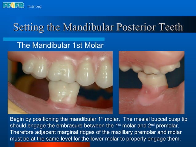 17.occlusal schemes anatomic and semiamatomic occlusion | PPT