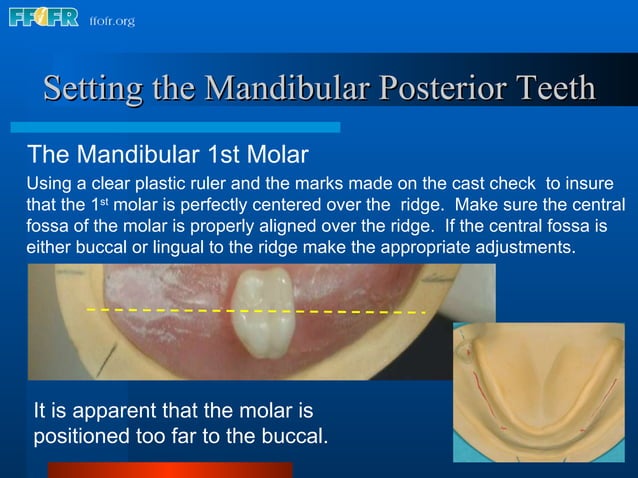 17.occlusal schemes anatomic and semiamatomic occlusion | PPT