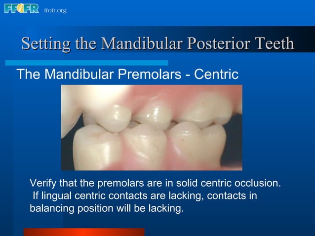 17.occlusal schemes anatomic and semiamatomic occlusion | PPT
