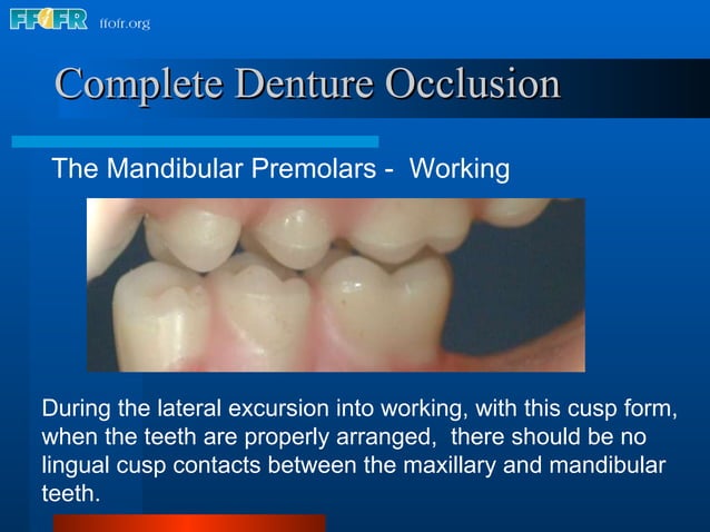 17.occlusal schemes anatomic and semiamatomic occlusion | PPT