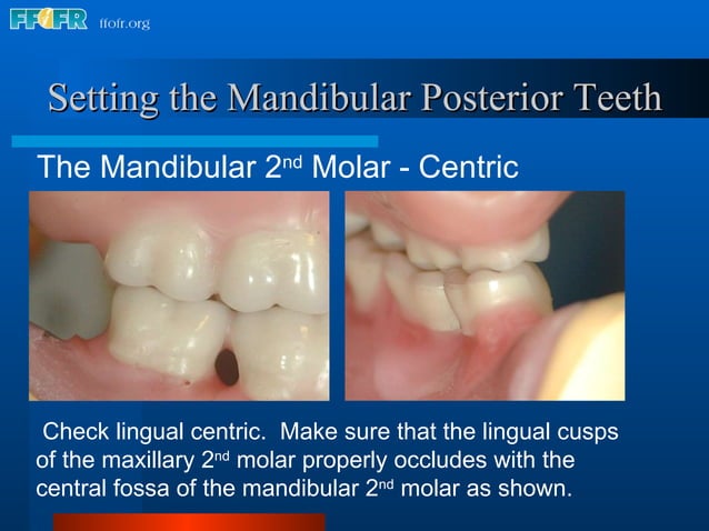 17.occlusal schemes anatomic and semiamatomic occlusion | PPT