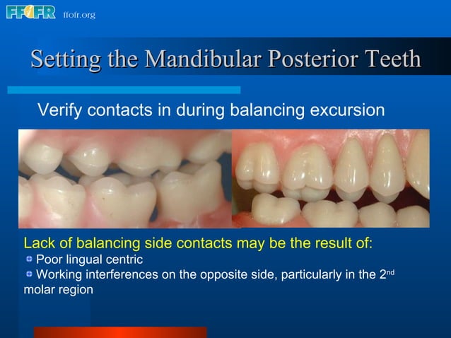17.occlusal schemes anatomic and semiamatomic occlusion | PPT
