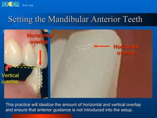 17.occlusal schemes anatomic and semiamatomic occlusion | PPT