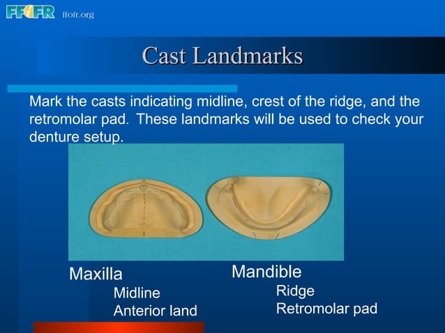 17.occlusal schemes anatomic and semiamatomic occlusion | PPT