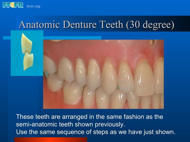 17.occlusal schemes anatomic and semiamatomic occlusion | PPT