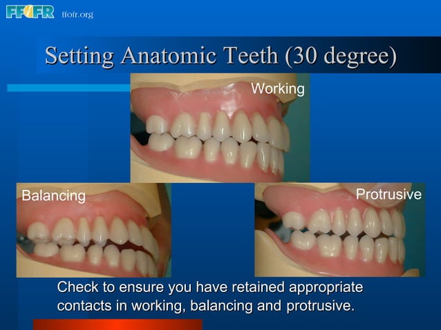 17.occlusal schemes anatomic and semiamatomic occlusion | PPT
