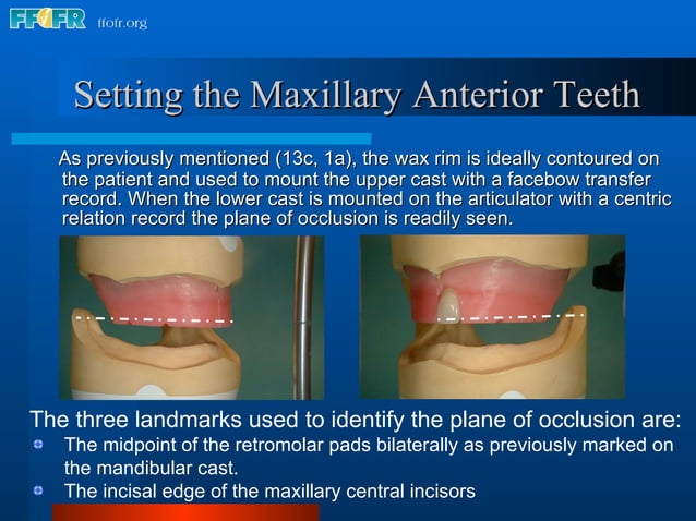 17.occlusal schemes anatomic and semiamatomic occlusion | PPT
