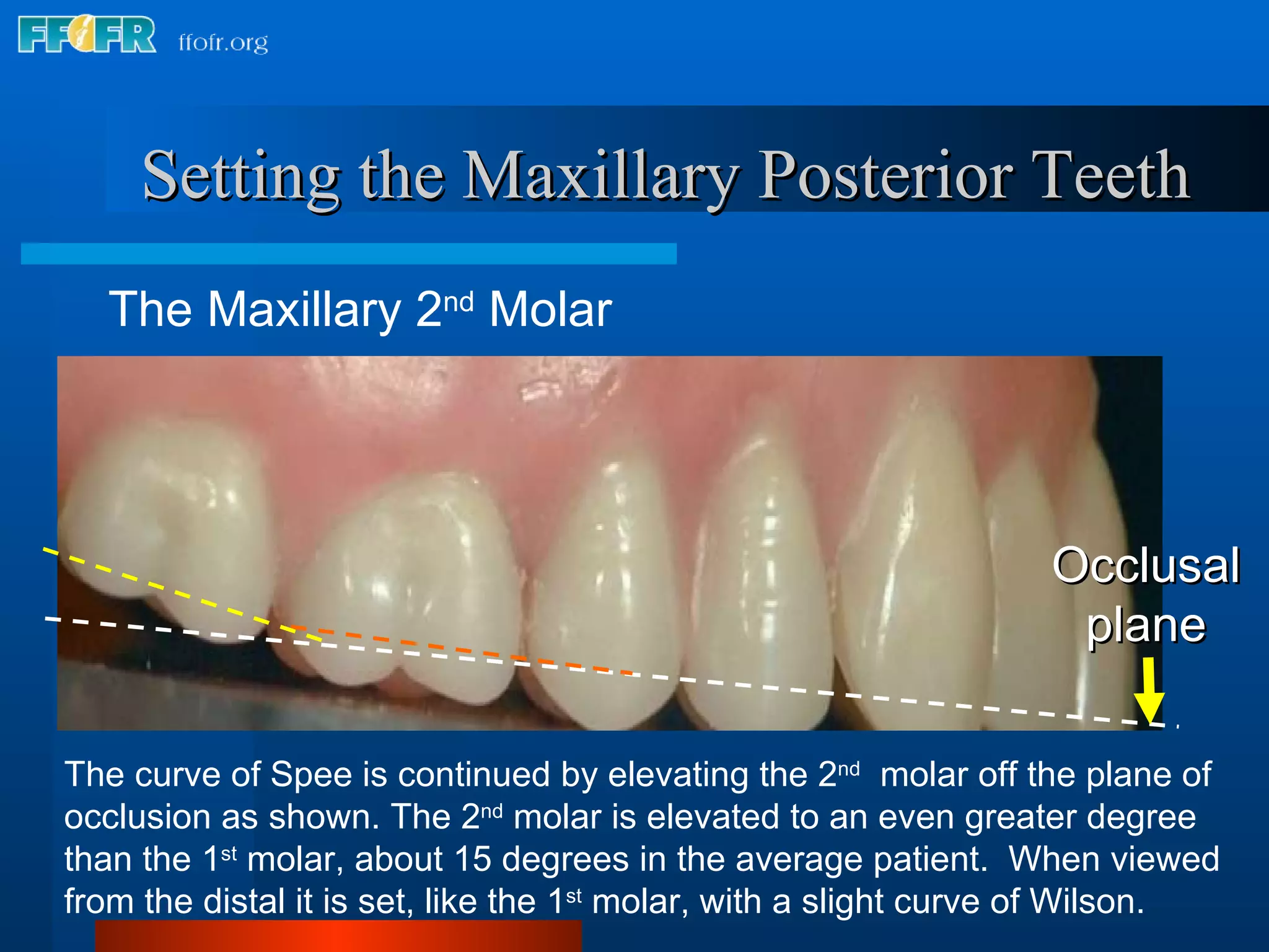 17.occlusal schemes anatomic and semiamatomic occlusion | PPT